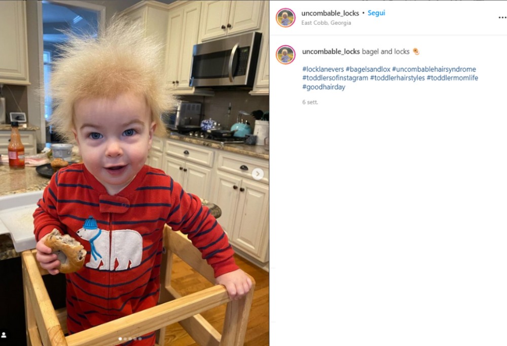 Locklan: il bimbo con la sindrome dei capelli spettinati - Radio 105