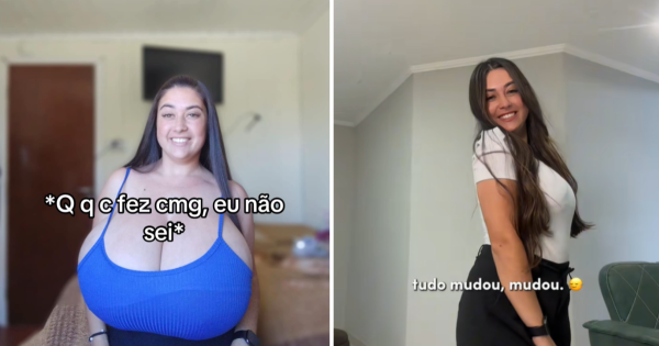 Quando un seno da 12 kg ti toglie la libertà di camminare - Radio 105